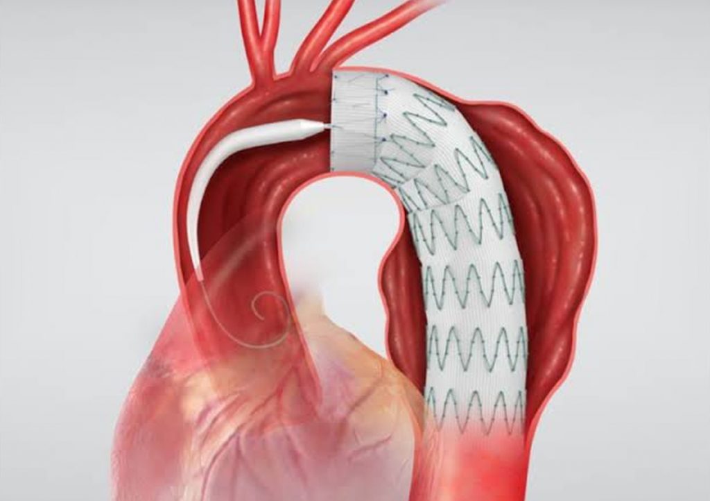 Cirurgia de Aorta Endovascular SP | Cirurgião Cardíaco SPKipCor